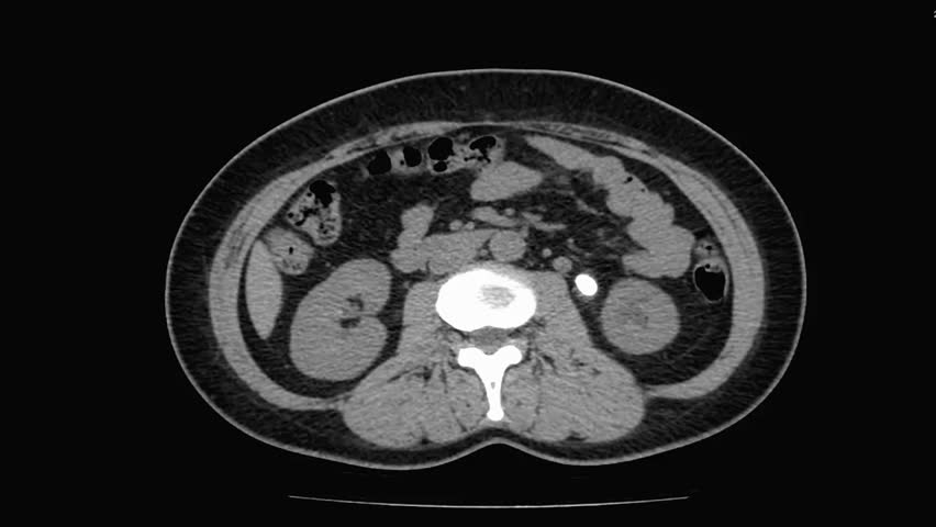 Abdomen Ct Scan Of Kidneys With Stones
