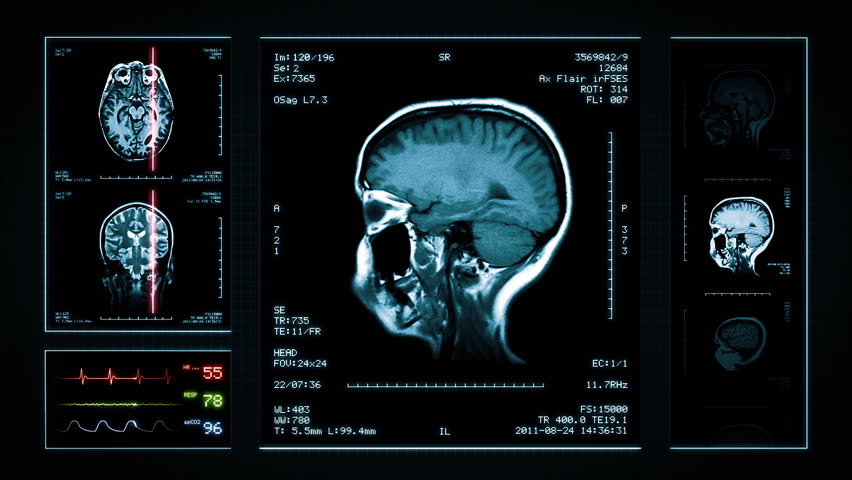 Three Head Views Of MRI Scan. Loopable. Blue. See More Color Options In ...