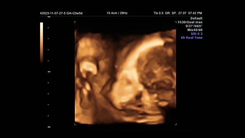 4D Ultrasound Ecography. Gynecological Medical Examination. 22 Weeks ...