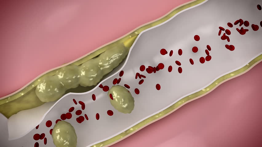 Coronary Embolus Travels Through the Stock Footage Video (100% Royalty ...