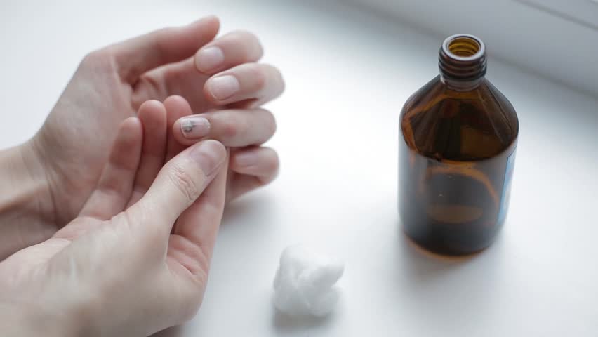 Horrible Trauma Of Fingernail. Subungual Hematoma. Bruise Under The ...